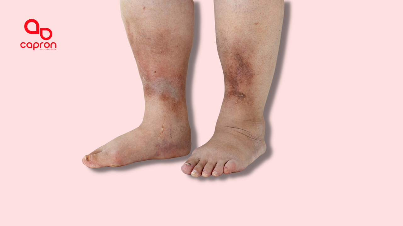 Kenali Diabetic Foot, Komplikasi Kaki Akibat Diabetes - Capron ...