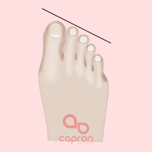 7 Macam Bentuk Kaki Manusia, Kamu yang Mana? - Capron Podologie Indonesia