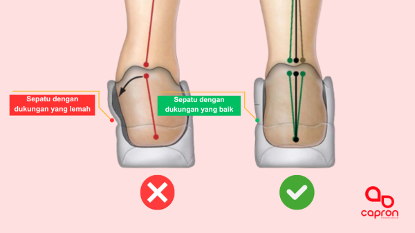 Supinasi Kaki Berlebih: Apa itu dan Penyebabnya? - Capron Podologie ...