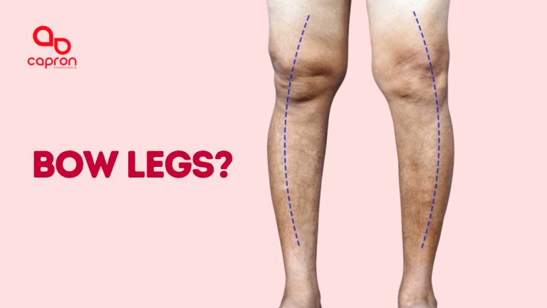 Cara Ampuh Mengatasi Bentuk Kaki O (Bow Legs) - Capron Podologie Indonesia