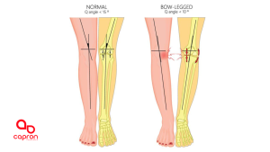 Cara Ampuh Mengatasi Bentuk Kaki O (Bow Legs) - Capron Podologie Indonesia